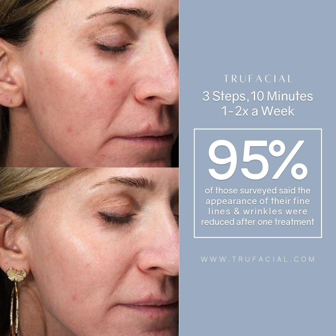 Trufacial At-Home Skin Rejuvenation Device for Radiant, Healthy Skin